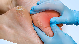 Diabetická noha - popis, liečba a odporúčania lekárov