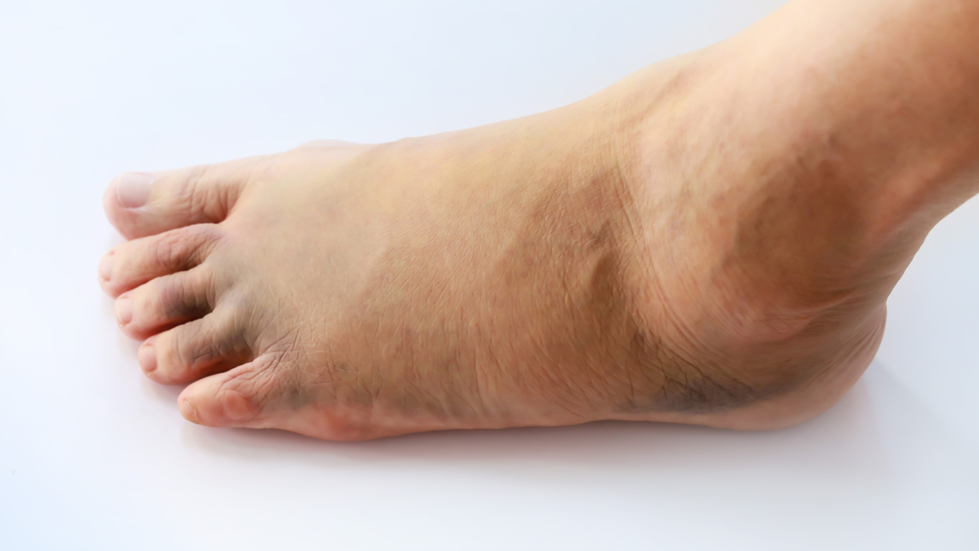 Zlomeniny - diagnostika, typy, účinné hojenie zlomenín